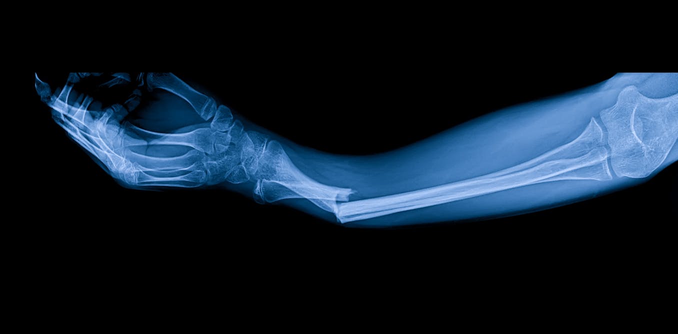 Bone-building drug which prevents fractures in people with osteoporosis ...