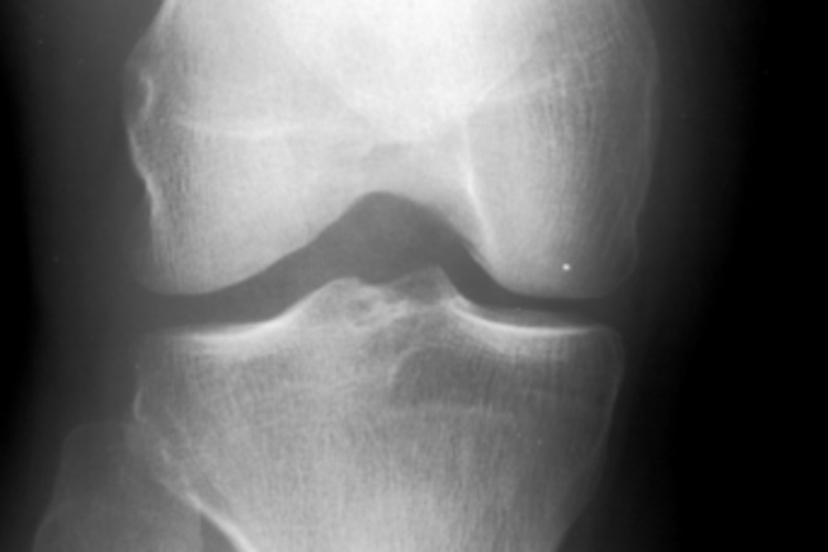This small walking style change can delay knee surgery for years, study ...